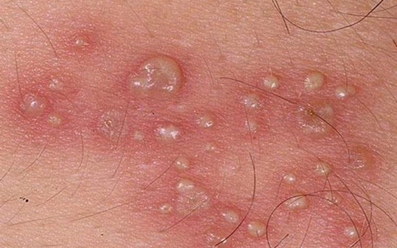 Bệnh Chlamydia là gì? Có phương pháp nào chữa khỏi không?